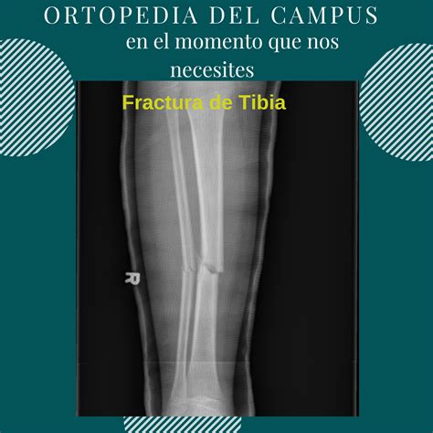 Fractura De Tibia Del Campus Ortopedia