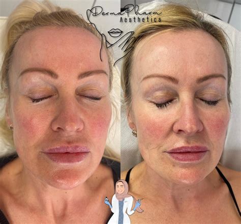 Profhilo And Ejal40 Skin Boosters DermaPharm Aesthetics