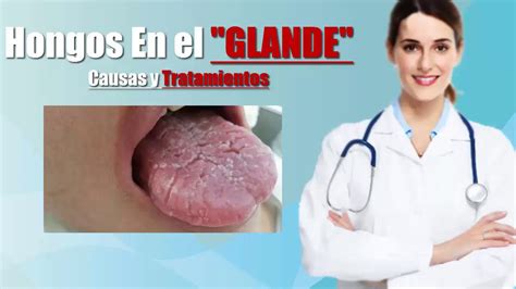 Hongos En El Gland3 Causas Y Tratamientos Doctora Valeria Peroski YouTube
