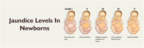 Livelli Di Ittero Neonatale Cause E Trattamenti