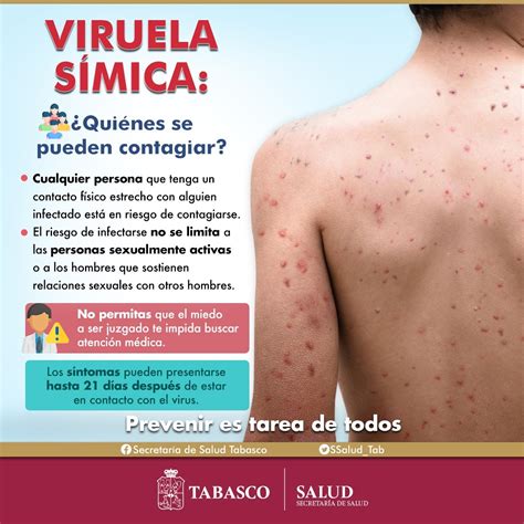 SSalud Tabasco on Twitter Recuerda El virus de la ViruelaSímica no