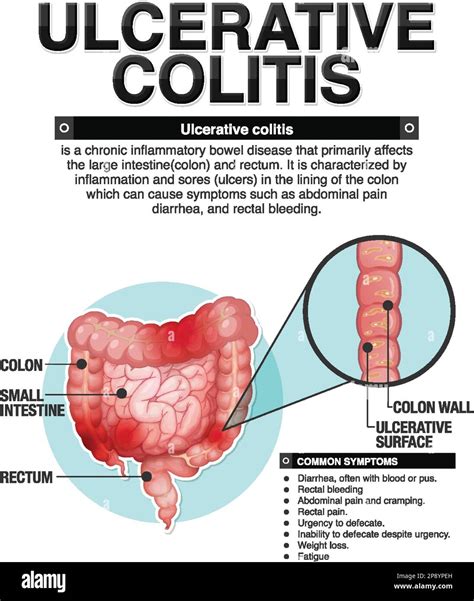 Ulcerative Colitis Treatment Options Info