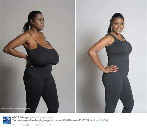 Rare Condition Causes Texas Woman To Undergo Reduction For 36NNN Breasts