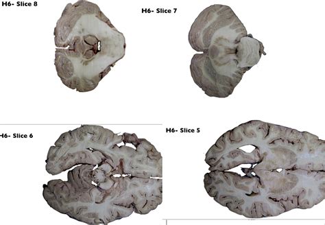 Horizontal Brain Slice Pt Diagram Quizlet