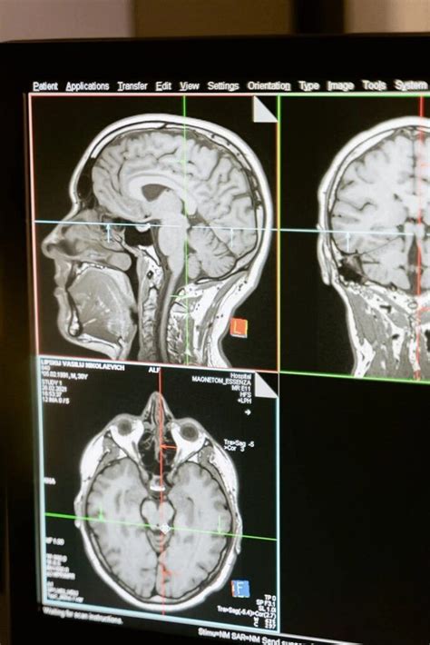 Derrame Cerebral Qu Es Y Cu Les Son Sus Causas