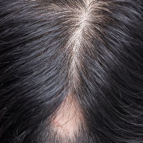 The Ultimate Guide How To Stop Alopecia Areata From Spreading