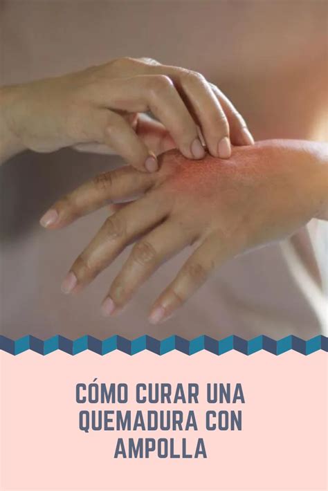Cómo curar una quemadura con ampolla lo que debes hacer y lo que