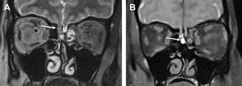 Imaging Of Cerebrospinal Fluid Rhinorrhea And Otorrhea Radiologic Clinics