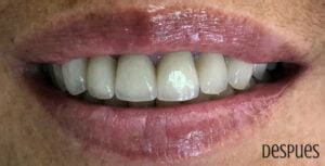 Diseño de Sonrisas Clinica de Estética Dental en Santiago