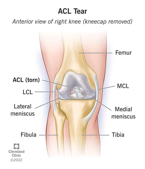 Understanding Anterior Cruciate Ligament ACL Injuries Ask The Nurse