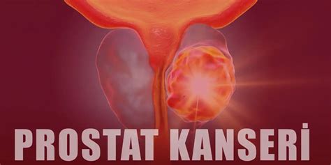 Prostat Kanseri Nedir Nedenleri Belirtileri Ve Tedavisi