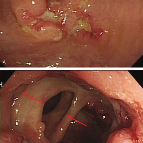 Ct Findings A Cm Size Colonic Mass In Ascending Colon Red