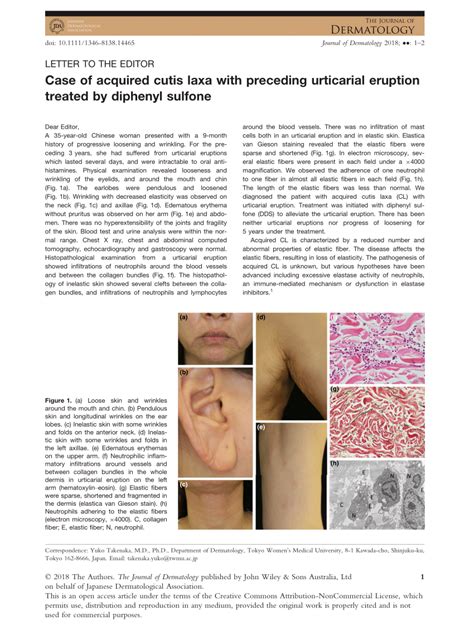 Pdf Case Of Acquired Cutis Laxa With Preceding Urticarial Eruption