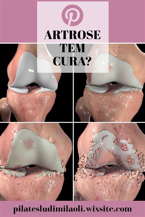 Artrose Interapofisária Tem Cura LIBRAIN