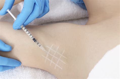 Why Do I Sweat So Much Illuminate Skin Clinics