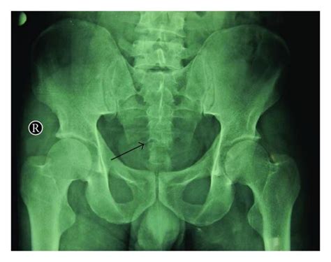 The Anteroposterior Roentgenogram Of The Lumbosacral Area Demonstrating