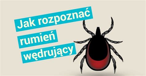 Zdjecie Rumienia Po Ugryzieniu Kleszcza 24648 Hot Sex Picture