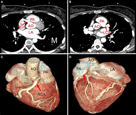 Anomalous Origin Of Left Coronary Artery From The Pulmonary Artery And