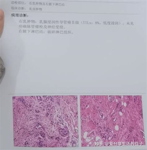 妈妈确诊乳腺癌 一 乳腺癌早期症状 乳腺癌治疗费用 知乎