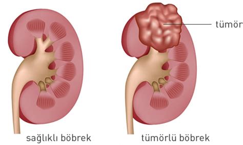 Böbrek Kanseri Tümörü Prof Dr Tahir Karadeniz