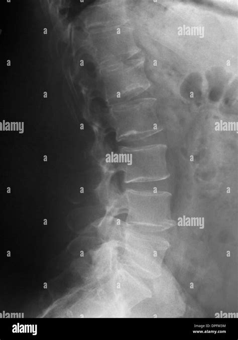 Anatomy Of Lumbar Spine High Resolution Stock Photography And Images
