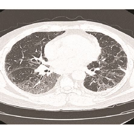CT High Resolution Chest Without Contrast Taken 15 Months Before Acute