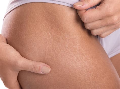 Stretch Marks Treatment London Advance Laser Removal