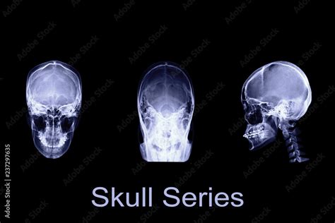 X Ray Image Of Human Skull Name Is Skull Series AP LAT Towne S View