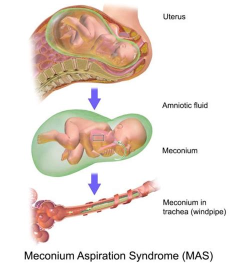Pin En Birth Injury