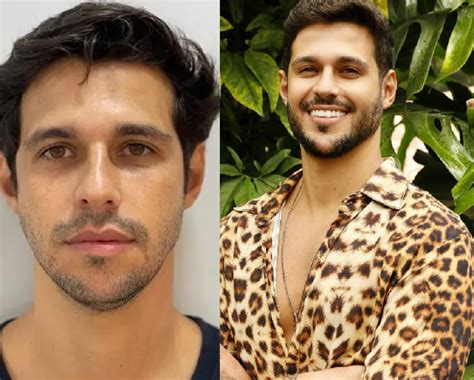 Rodrigo fez harmonização facial antes do BBB 22 veja antes e depois