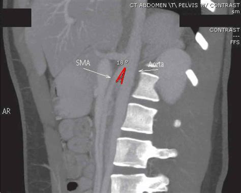Mesenteric Artery Anatomy Function Branches Mesenteric Artery Ischemia