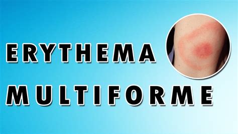 Erythema Multiforme Target Lesion Youtube