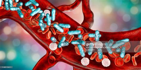 Case Report Neisseria Meningitidis Sepsis In A Patient With PNH