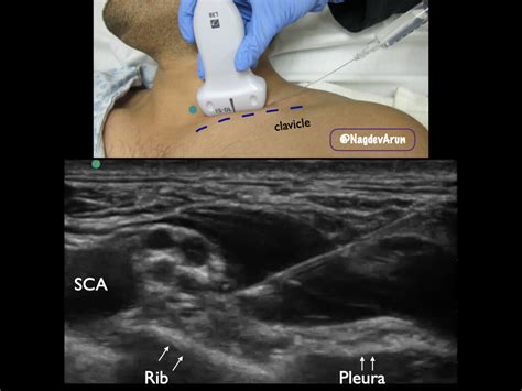 Supraclavicular Brachial Plexus Highland EM Ultrasound Fueled Pain
