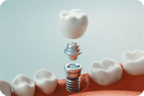 IMPLANTODONTIA Zanardi Dental Clinic
