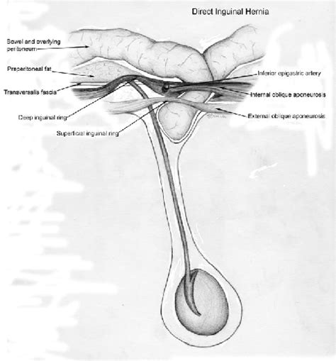 Direct Inguinal Hernia Diagram Images And Photos Finder