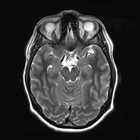 Normal Brain MRI Radiology Case Radiopaedia Org Mri Brain Scan