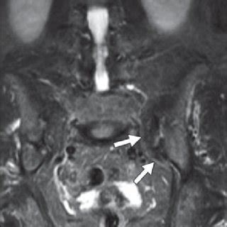 Year Old Woman With History Of Osteoporosis And Lumbar Canal Stenosis