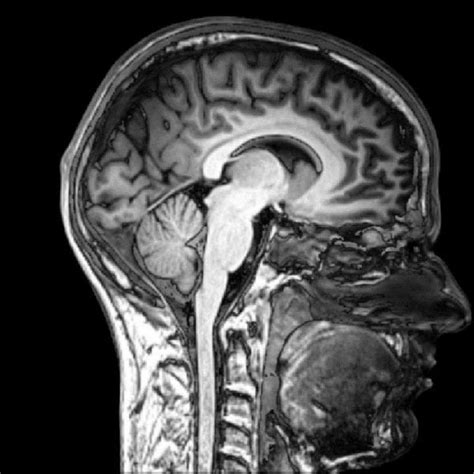 Mri Brain Without Contrast Change Comin