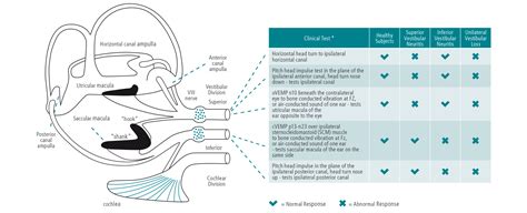 Diagnosing Peripheral Vestibular Disorders Natus