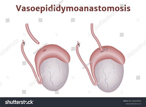 Difference Between Castration And Vasectomy Off