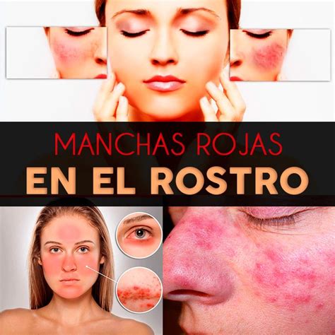 Manchas Rojas En La Cara Causas Y Tratamiento La Guía de las Vitaminas