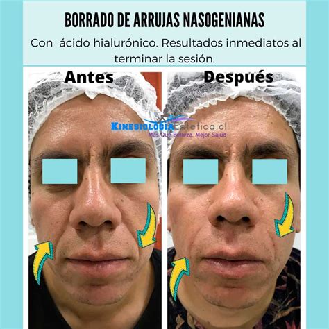 Acido Hialuronico Antes Y Despues Hombre Kinesiologiaestetica Cl