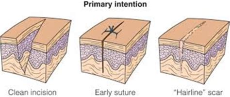 Wounds Wound Healing Soft Tissue Injury And Masses Flashcards Quizlet