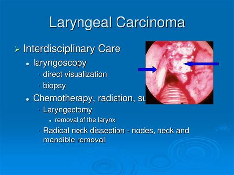 Pathophysiology Of Laryngeal Cancer