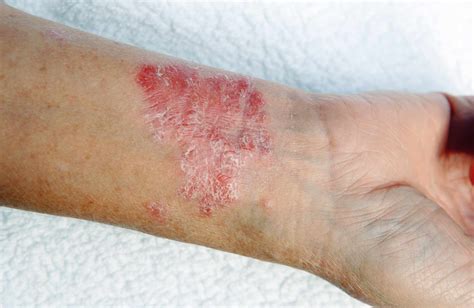 Síntomas de la psoriasis Medicina Básica