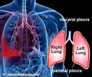 Pleurisy Causes Symptoms Diagnosis Treatment Complications