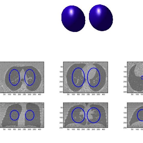 splitting of a surface during 3d image segmentation using a level set download scientific