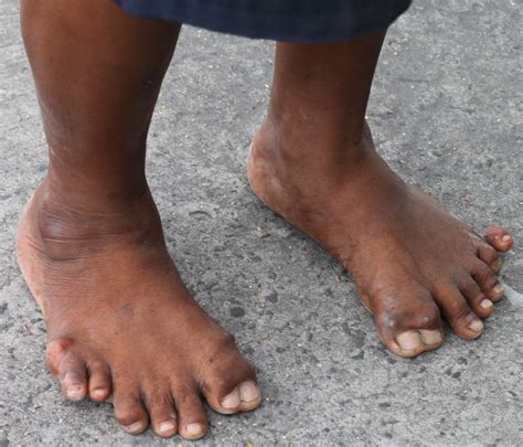 Sintético 9 Foto Los Pies Más Feos Del Mundo Mirada Tensa