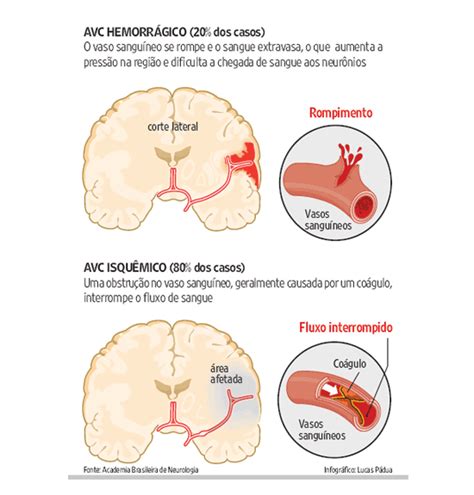 Saúde e bem estar O que é Acidente Vascular Cerebral